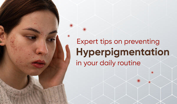 Expert Tips on Preventing Hyperpigmentation in Your Daily Routine